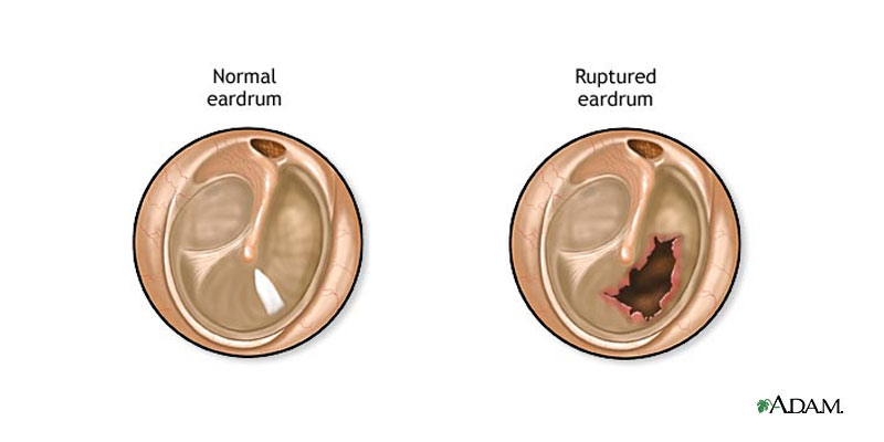 Perforated Ear Drum - ENT Clinic