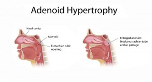 Adenotonsillar hypertrophy - ENT Clinic Sydney